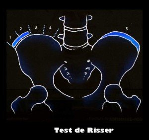 Escoliosis | Linares Con Isidro